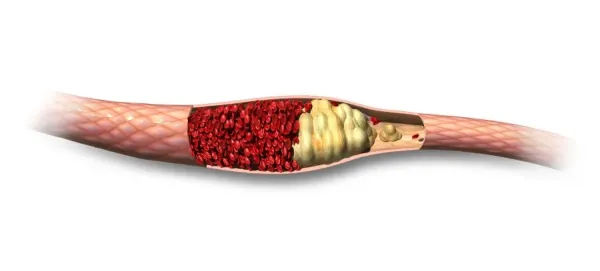 Atheromatous artery, artwork C015 / 6446 Our beautiful Wall Art and ...