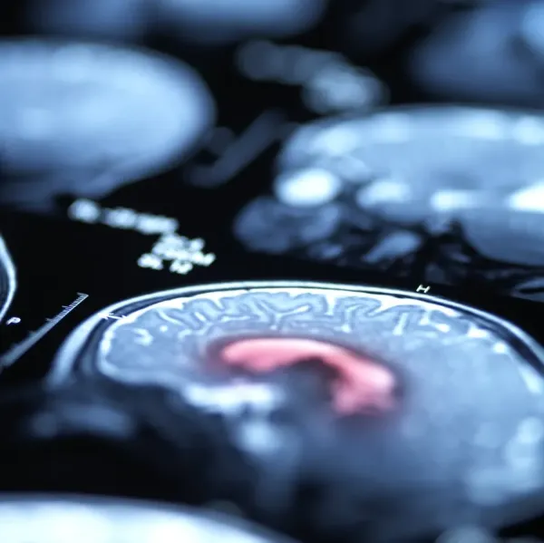 Brain scans. Sagittal (sideways) scan through the head