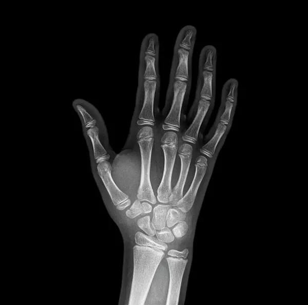 Xray Definition Types Of Xrays Broken Bones Xray
