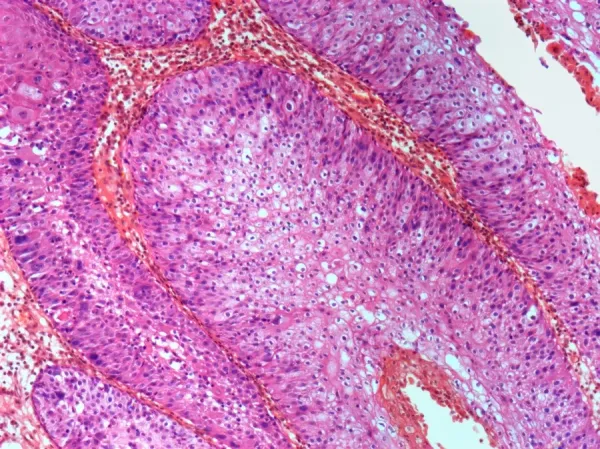 Wart, light micrograph Our beautiful Wall Art and Photo Gifts include ...