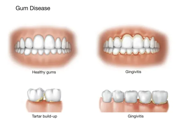 Healthy Gums Look Like