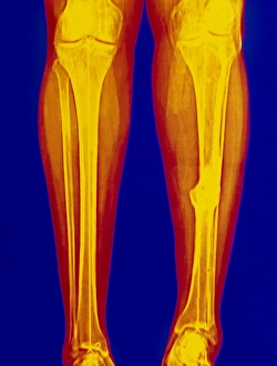 Leg Fracture Prints